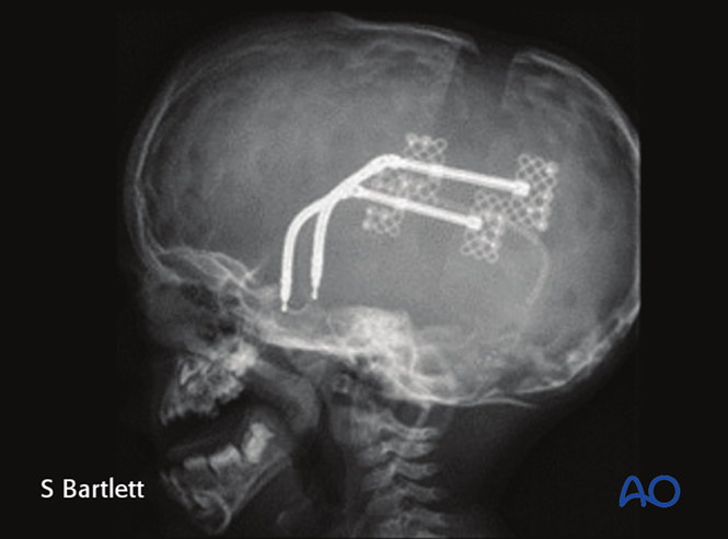 Posterior vault expansion by distraction osteogenesis for Syndromic ...