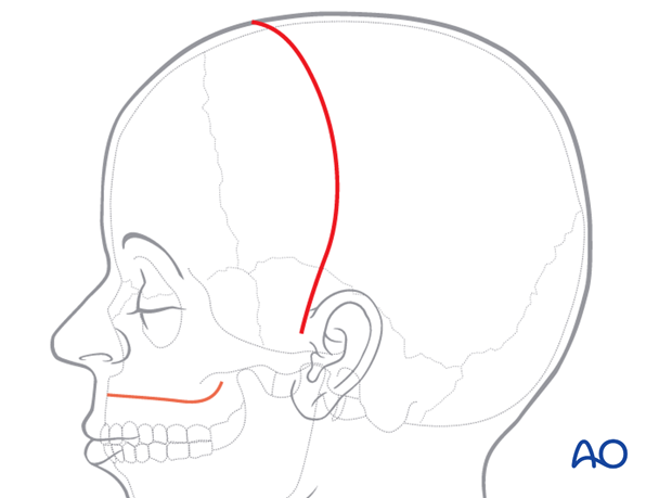 Four wall box osteotomy of the orbits for Intraorbital hypertelorism