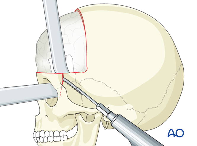 Four wall box osteotomy of the orbits for Intraorbital hypertelorism