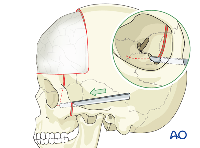 Four wall box osteotomy of the orbits for Intraorbital hypertelorism