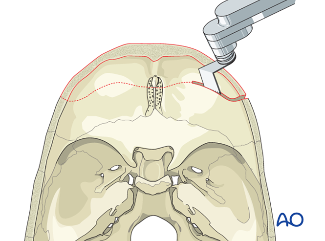 Four wall box osteotomy of the orbits for Intraorbital hypertelorism