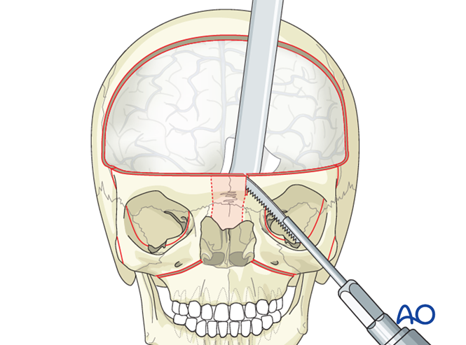 Four wall box osteotomy of the orbits for Intraorbital hypertelorism