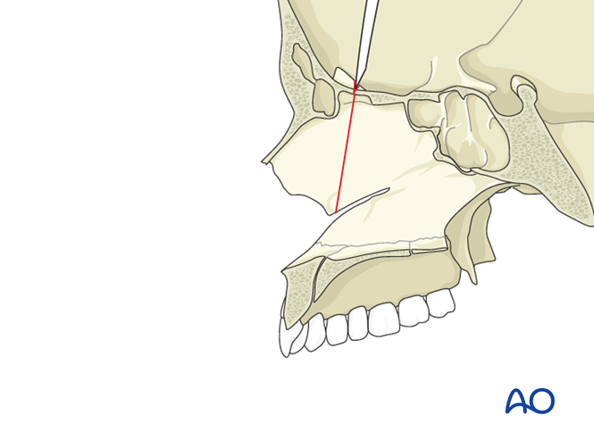 Four wall box osteotomy of the orbits for Intraorbital hypertelorism