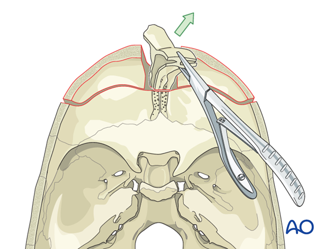 Four wall box osteotomy of the orbits for Intraorbital hypertelorism
