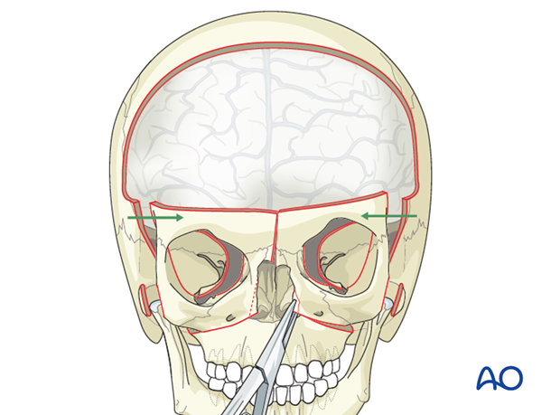 Four wall box osteotomy of the orbits for Intraorbital hypertelorism