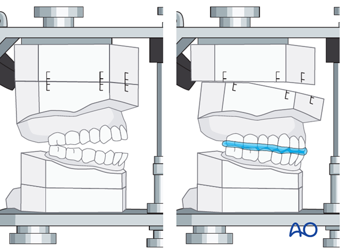 Symmetric facial bipartition for Intraorbital hypertelorism with ...