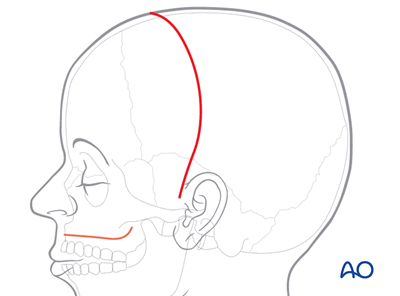 Symmetric facial bipartition for Intraorbital hypertelorism with ...