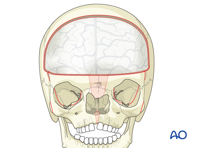 Symmetric facial bipartition for Intraorbital hypertelorism with ...