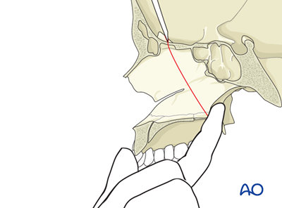 Le Fort III Monoblock - Conventional for Syndromic synostosis