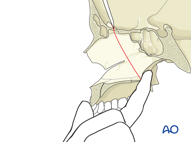 Le Fort III Monoblock - Conventional for Syndromic synostosis
