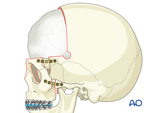 Symmetric facial bipartition for Intraorbital hypertelorism with ...