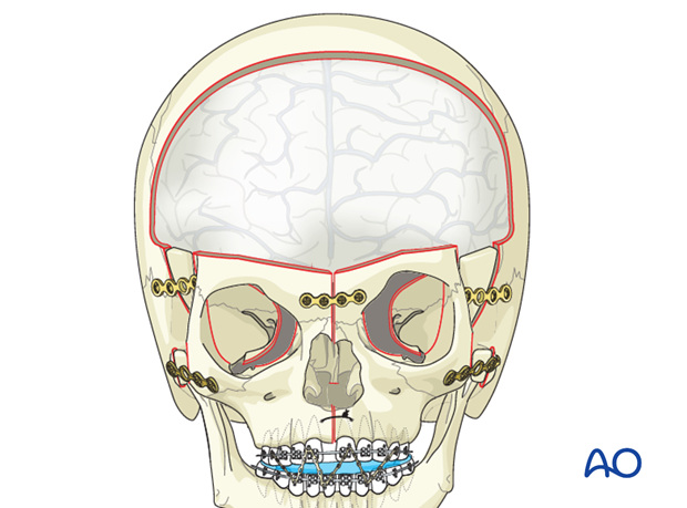 Symmetric facial bipartition for Intraorbital hypertelorism with ...