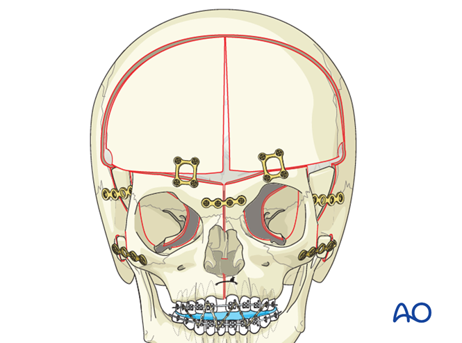 Symmetric facial bipartition for Intraorbital hypertelorism with ...