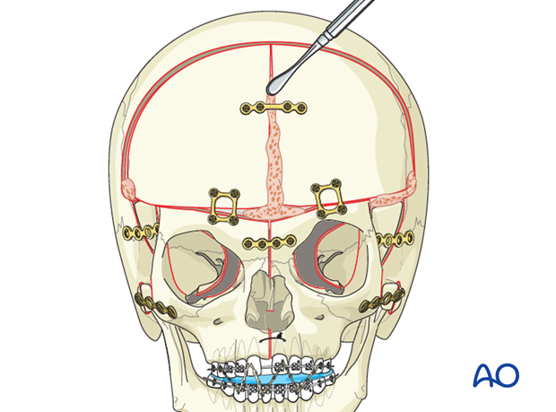 Symmetric facial bipartition for Intraorbital hypertelorism with ...