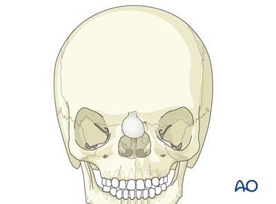Medial Orbital Composite - Unit Translocation for Interorbital ...
