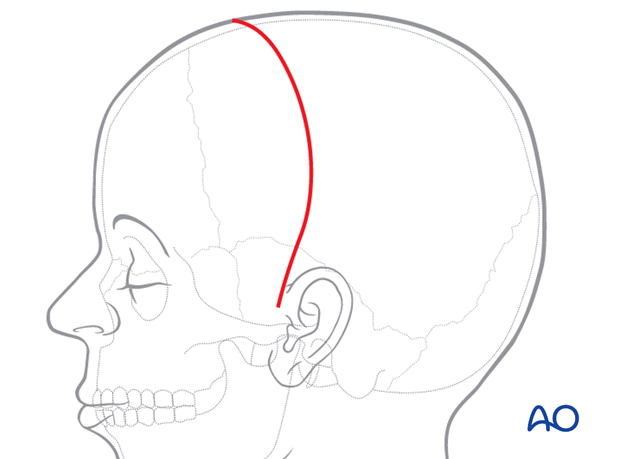 Medial Orbital Composite - Unit Translocation for Interorbital ...