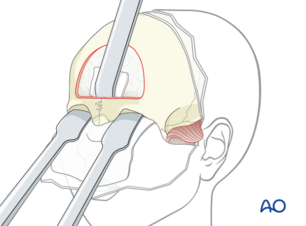 Medial Orbital Composite - Unit Translocation for Interorbital ...