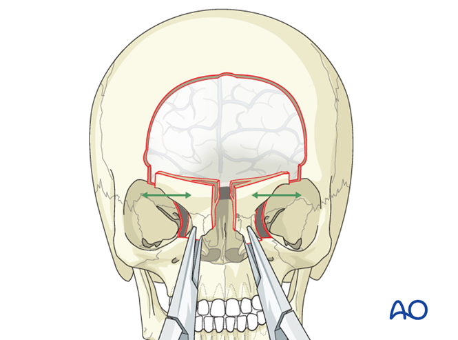 Medial Orbital Composite - Unit Translocation for Interorbital ...