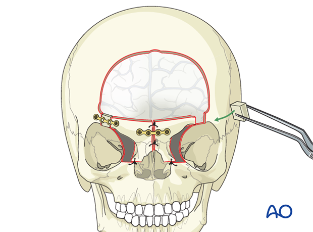 Medial Orbital Composite - Unit Translocation for Interorbital ...