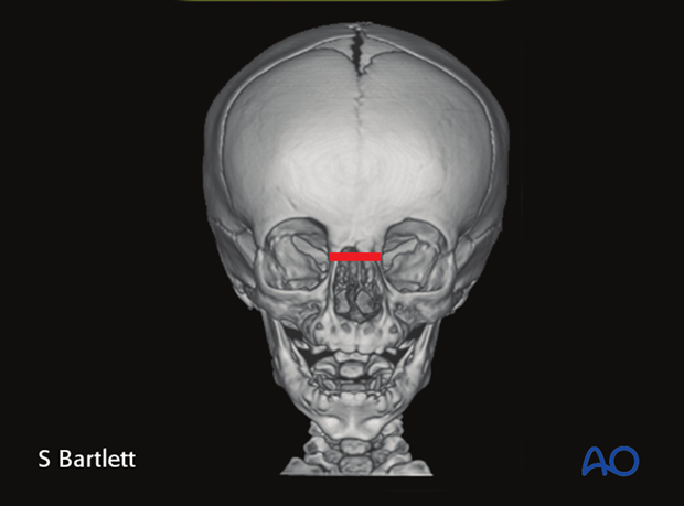 Medial Orbital Composite - Unit Translocation for Interorbital ...