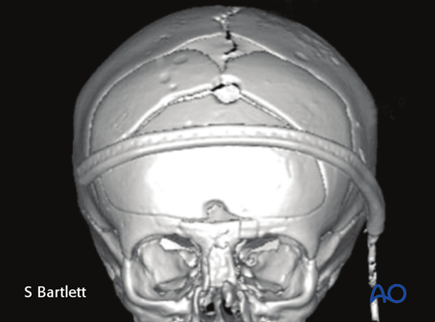 Medial Orbital Composite - Unit Translocation for Interorbital ...
