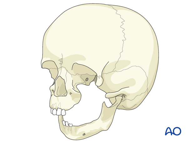 Orbit malar construction with vascularized bone graft for Treacher ...