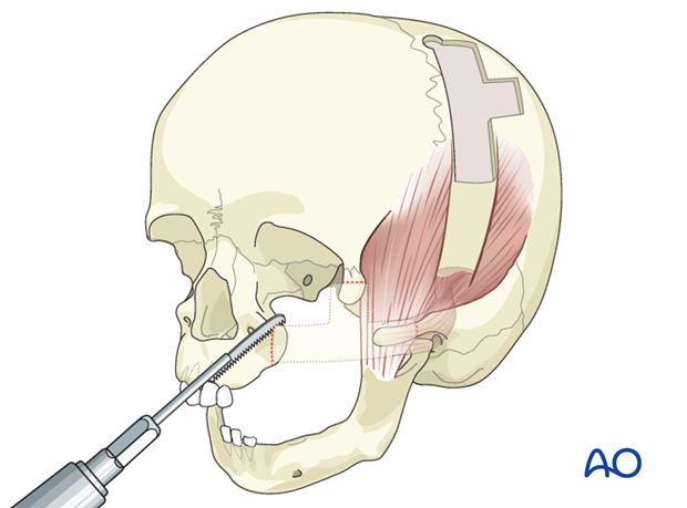 Orbit malar construction with vascularized bone graft for Treacher ...