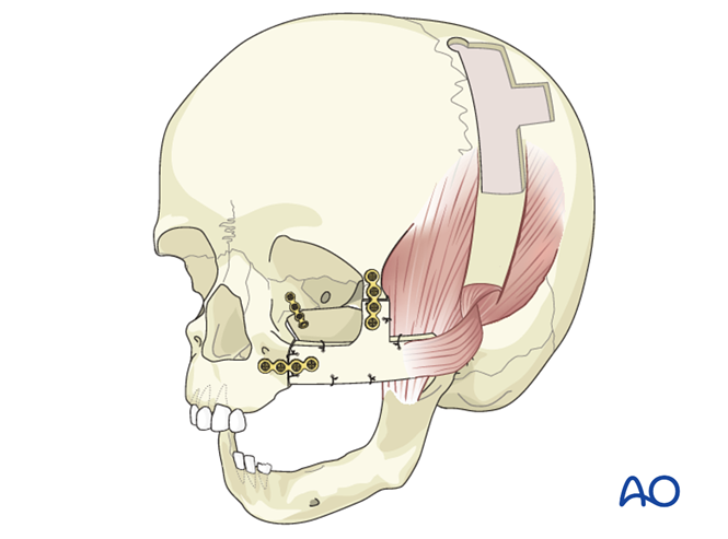 Orbit malar construction with vascularized bone graft for Treacher ...