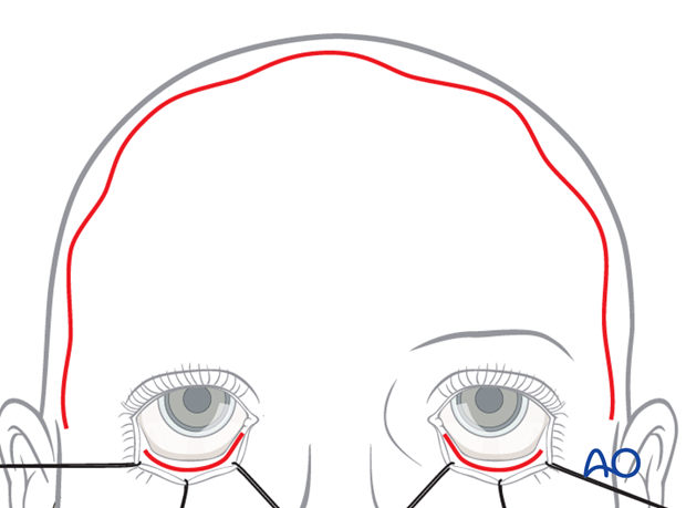 Orbit malar construction with vascularized bone graft for Treacher ...