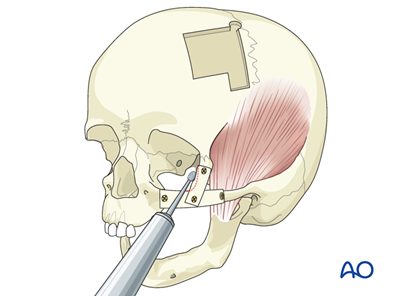 Orbit malar construction with free bone graft for Treacher Collins Syndrome