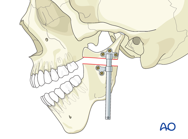 Distraction osteogenesis of the mandibular ramus for Treacher Collins ...