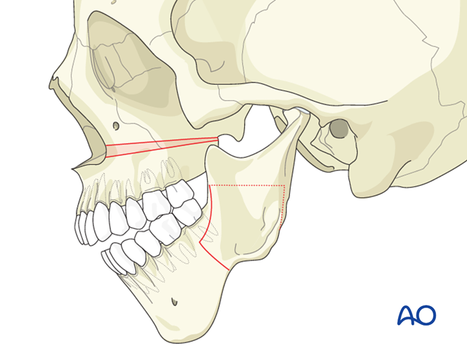 Conventional orthognathic surgery for Treacher Collins Syndrome