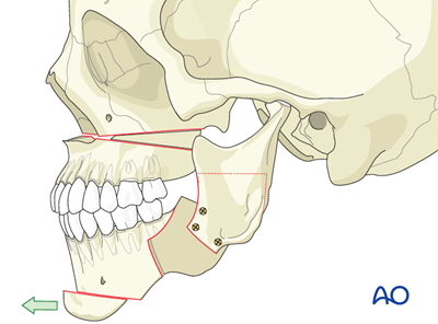 Conventional orthognathic surgery for Treacher Collins Syndrome
