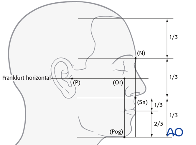 Planning of orthognathic surgery