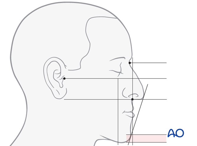 Planning of orthognathic surgery