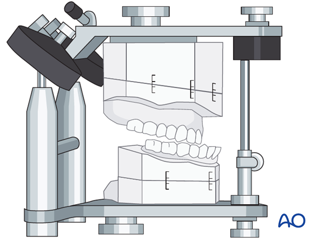 Planning of orthognathic surgery