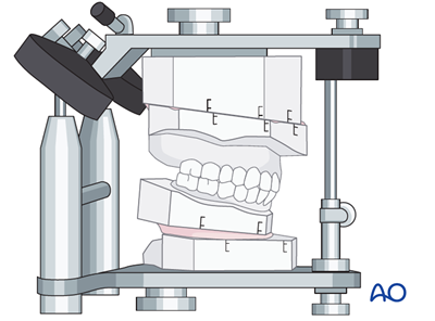 Subapical (block) osteotomy for Mandibular alveolar protrusion
