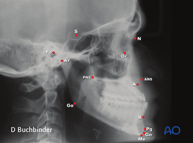 Planning of orthognathic surgery