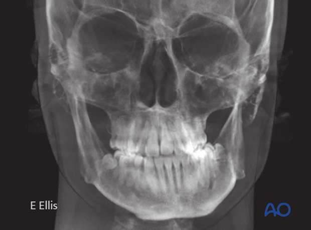 Condylar hyperplasia
