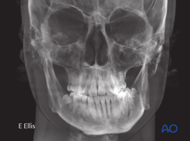 Condylar hyperplasia