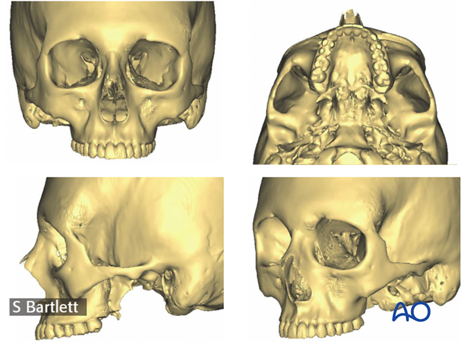 Radical excision and reconstruction for Limited fibrous dysplasia