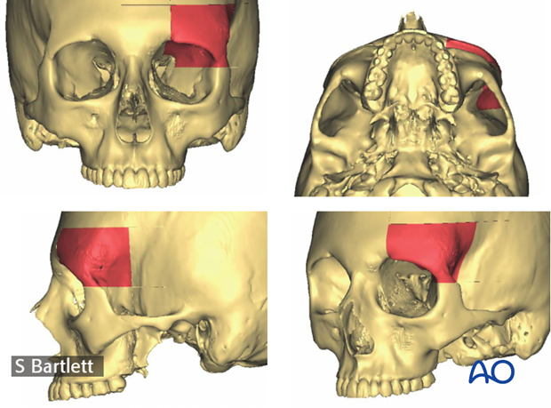 Radical excision and reconstruction for Limited fibrous dysplasia