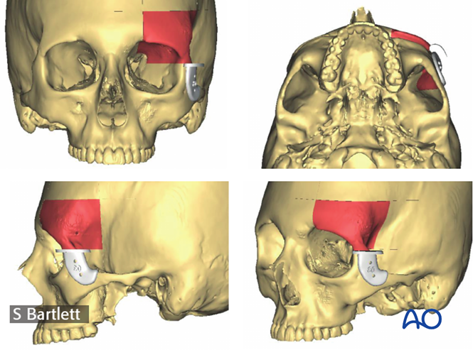 Radical excision and reconstruction for Limited fibrous dysplasia