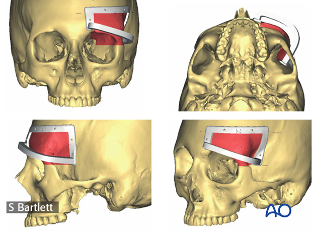 Radical excision and reconstruction for Limited fibrous dysplasia