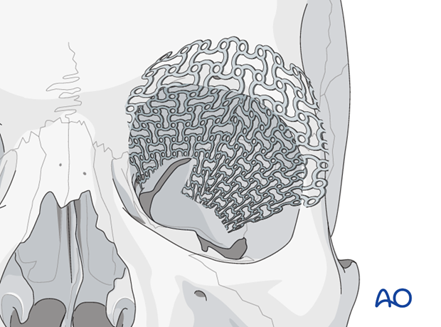 Radical excision and reconstruction for Limited fibrous dysplasia