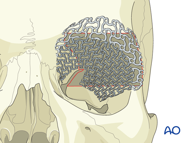 Radical excision and reconstruction for Limited fibrous dysplasia