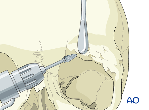 Partial ostectomy and contouring for Limited fibrous dysplasia