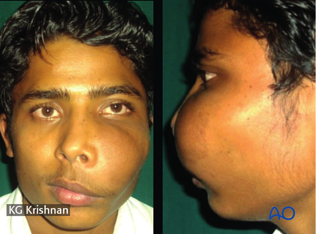 Partial ostectomy and contouring for Extensive fibrous dysplasia