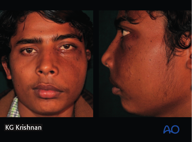 Partial ostectomy and contouring for Extensive fibrous dysplasia