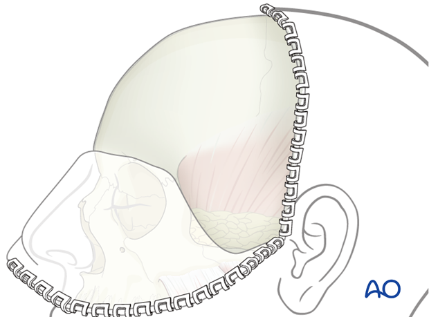 Optic nerve decompression with limited resection for Fibrous dysplasia ...